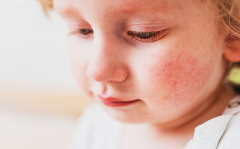 New website helps improve eczema in children and young people ...