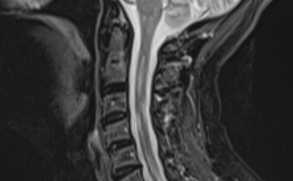 Cervical Spine Mri Ms