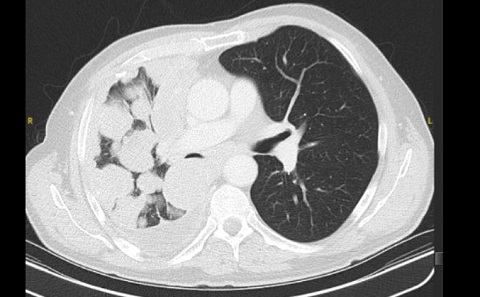 New hope for patients with aggressive asbestos-linked cancer as trial ...